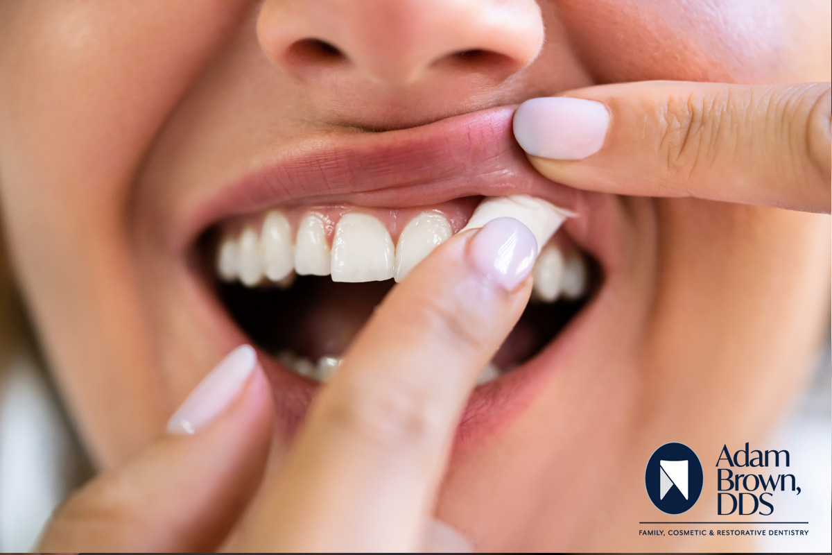 Nicotine Pouch Effects On Teeth & Gums